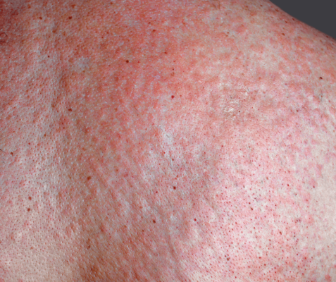 Alergia al sol - alergias.de - CONADEIP